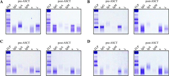 Comparison of SPE, IFE, and FLC in Monitoring Patients with Multiple ...