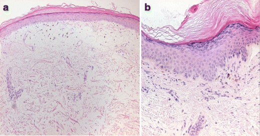 Cutaneous Manifestations in Dermatomyositis: Key Clinical and ...