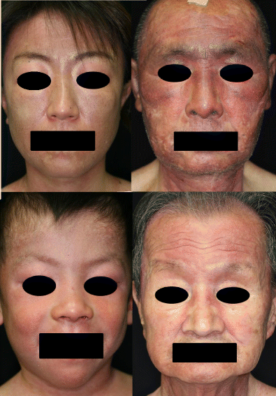 Cutaneous Manifestations in Dermatomyositis: Key Clinical and ...