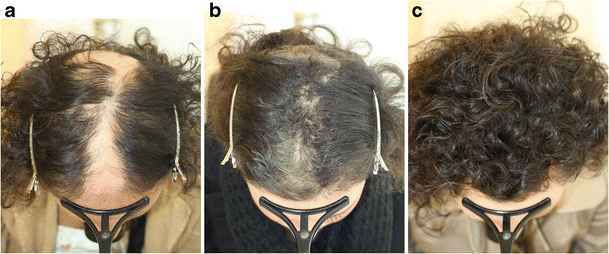 Alopecia Areata: a Comprehensive Review of Pathogenesis and Management ...