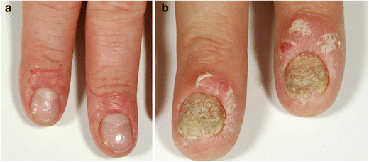 Skin Manifestations of Rheumatoid Arthritis, Juvenile Idiopathic ...