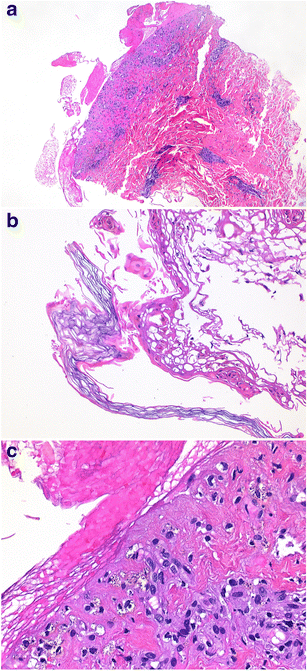 Current Perspectives on Stevens-Johnson Syndrome and Toxic Epidermal ...