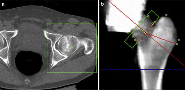 Opportunistic Screening for Osteoporosis Using Body CT Scans Obtained ...
