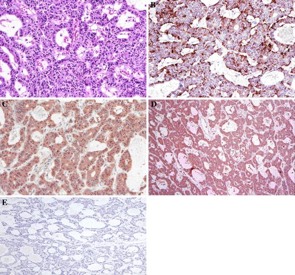 VIPoma with expression of both VIP and VPAC1 receptors in a patient ...