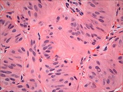 Hyalinizing Trabecular Tumor of the Thyroid: An Update | SpringerLink