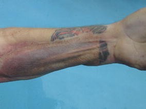 Tattoos: forensic considerations | SpringerLink