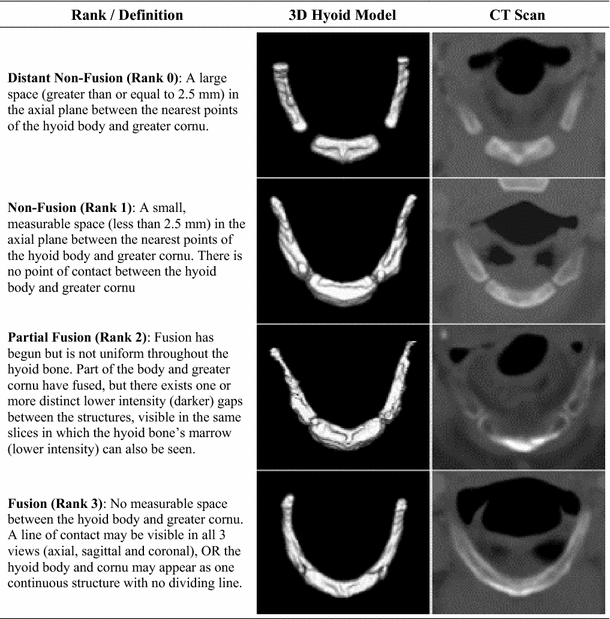 Hyoid bone fusion and bone density across the lifespan: prediction of ...