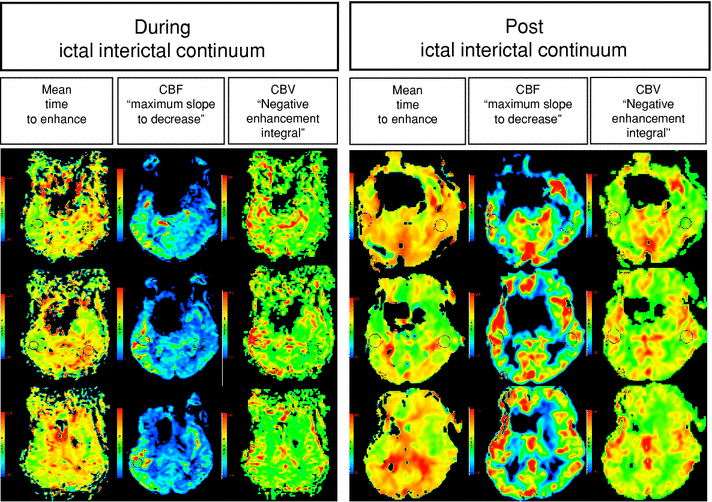 How I Treat Patients with EEG Patterns on the Ictal–Interictal ...