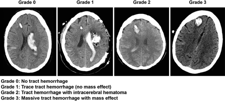Safety of Intraventricular Hemorrhage (IVH) Thrombolysis Based on CT ...