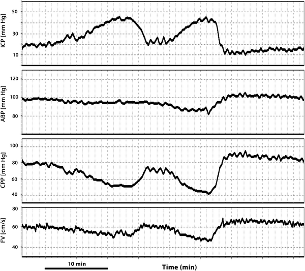 Critical Closing Pressure During Intracranial Pressure Plateau Waves ...