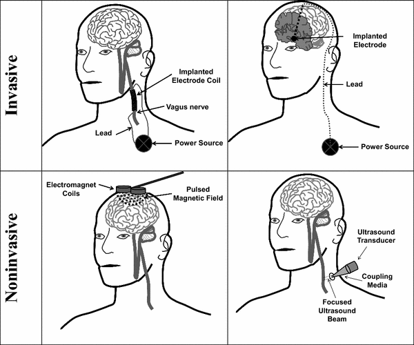 Vagus Nerve Stimulation and Other Neuromodulation Methods for Treatment ...