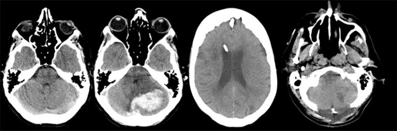 Acute Posterior Cranial Fossa Hemorrhage—Is Surgical Decompression ...