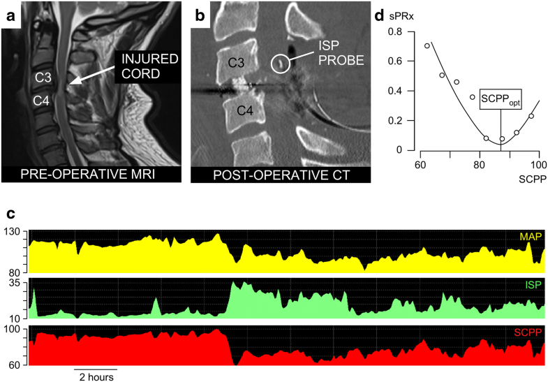 Predictors of Intraspinal Pressure and Optimal Cord Perfusion Pressure ...