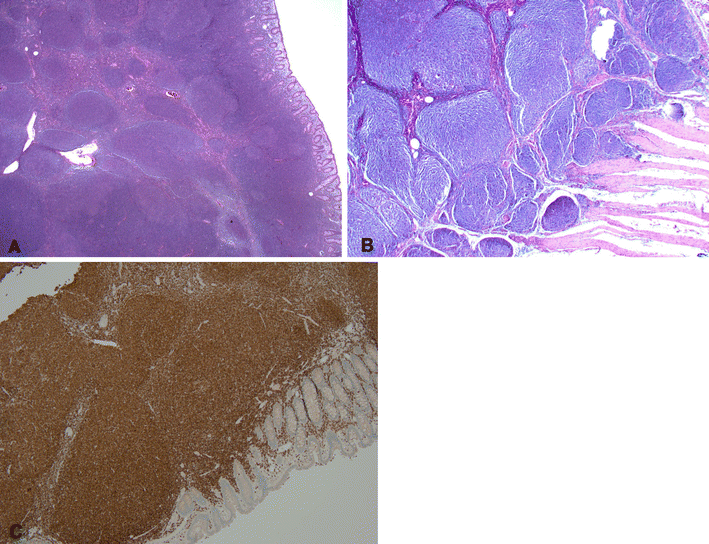 Colonic Perforation Following Polypectomy of a Gastrointestinal ...