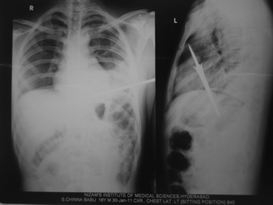 Penetrating chest trauma by an arrow | SpringerLink