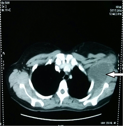 Tubercular cold abscess neck causing thoracic outlet syndrome ...