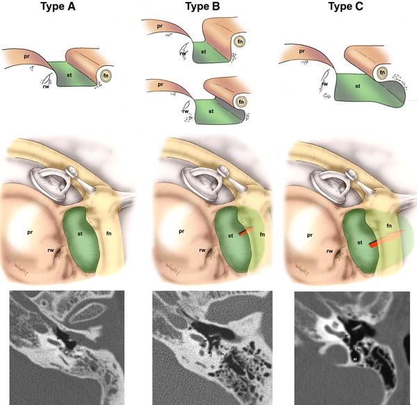 Endoscopic Anatomy of the Middle Ear | SpringerLink