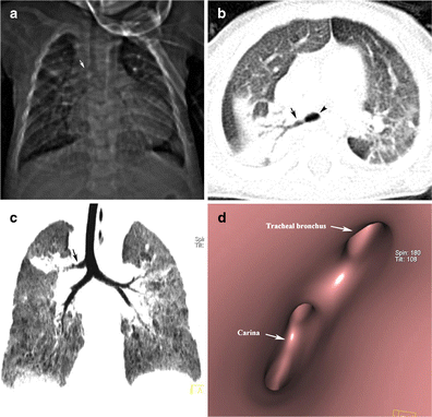 Tracheal Bronchus (Pig Bronchus) | SpringerLink