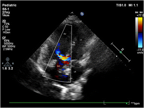 Tetralogy of Fallot with Restrictive Ventricular Septal Defect ...
