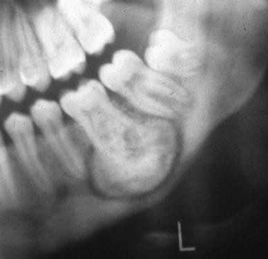 Cementoblastoma | SpringerLink