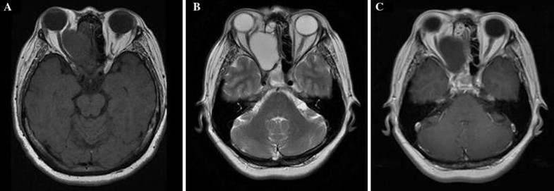 Paranasal Sinus Mucocele | SpringerLink