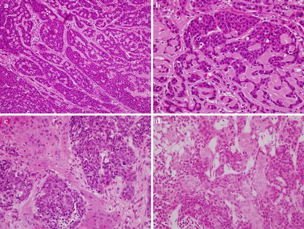 HPV-Related Squamous Cell Carcinoma Variants in the Head and Neck ...