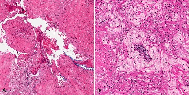 The Non-ossifying Fibroma: A Case Report and Review of the Literature ...