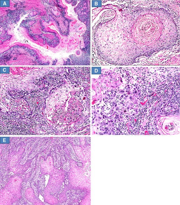 Carcinoma Cuniculatum of the Esophagus and Tongue: Report of Two Cases ...