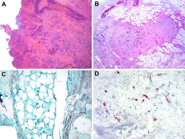 Pathology of Fungal Rhinosinusitis: A Review | SpringerLink