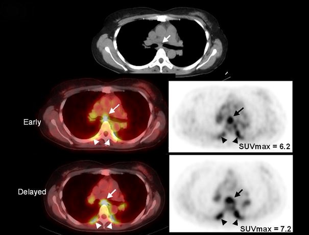 Differential diagnosis between 18F-FDG-avid metastatic lymph nodes in ...