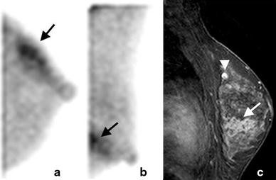 Usefulness of breast-specific gamma imaging as an adjunct modality in ...
