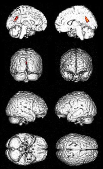 Cingulate island sign on FDG-PET is associated with medial temporal ...