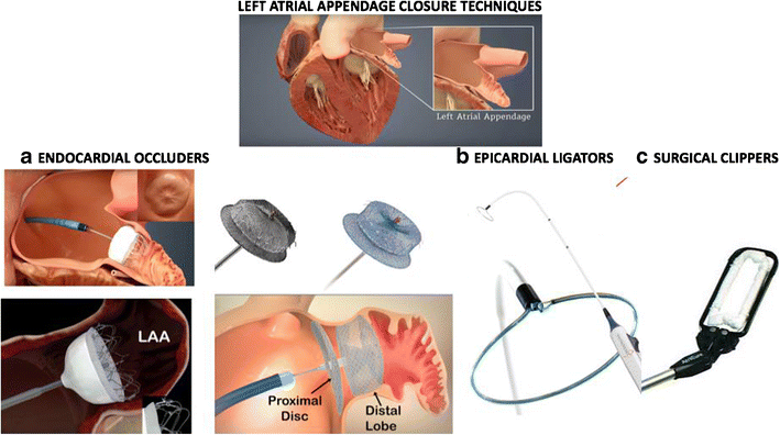 Left Atrial Appendage Closure: Is the Strategy Enough to Lower Long ...