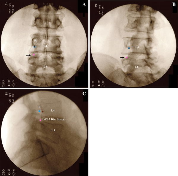 Complications and pitfalls of lumbar interlaminar and transforaminal ...