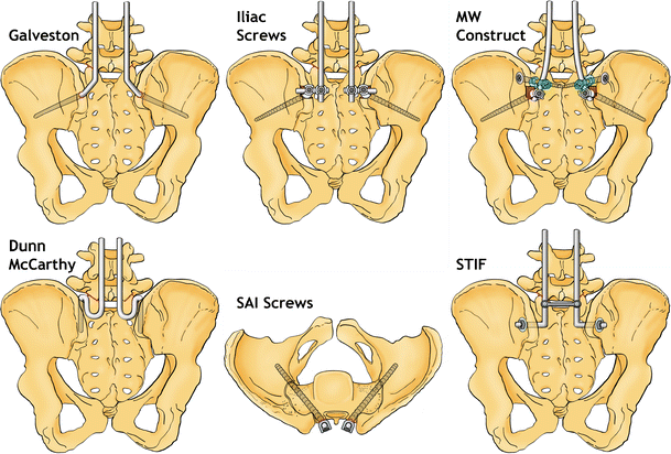 Pelvic fixation for neuromuscular scoliosis deformity correction ...