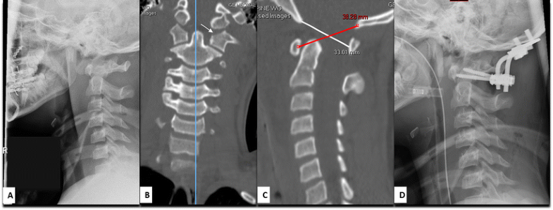 Occipitocervical dissociation—incidence, evaluation, and treatment ...