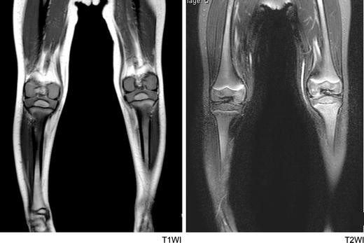 Case series of pediatric acute leukemia without a peripheral blood ...