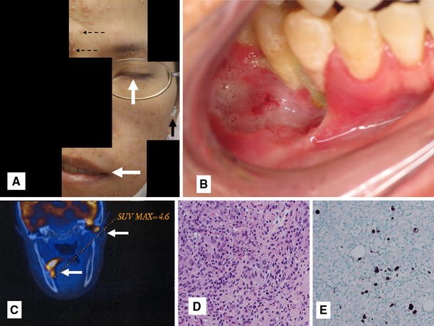 Multi-focal EBV-mucocutaneous ulcer heralding late-onset T-cell ...