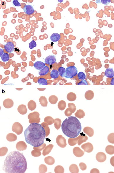 “Cup-like” blasts and NPM1 and FLT3 (ITD) mutations in acute myeloid ...