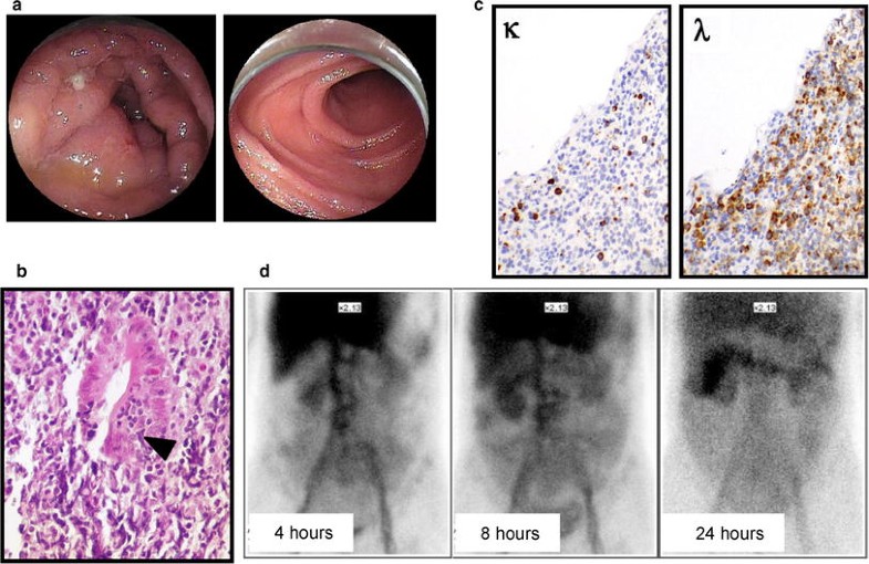 MALT lymphoma of the small bowel with protein-losing enteropathy ...
