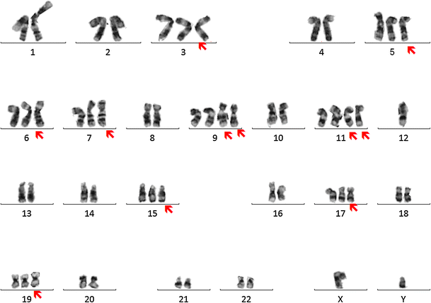 Complex hypodiploid acute myeloid leukaemia secondary to chemotherapy ...