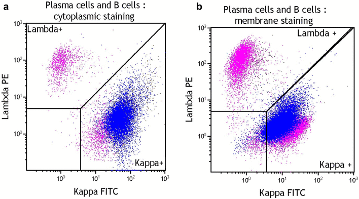 IgM k multiple myeloma with monoclonal surface immunoglobulin ...