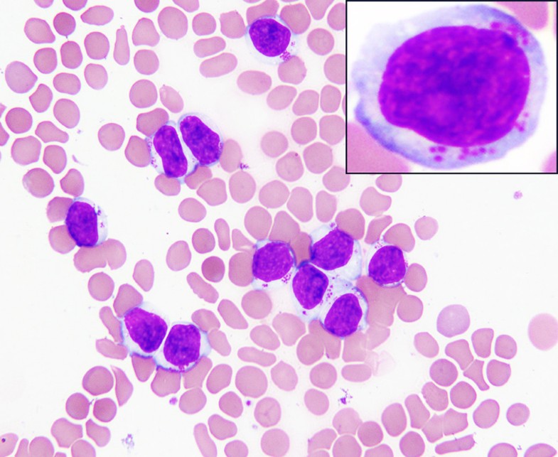 Intracytoplasmic azurophilic inclusions in prolymphocytes | SpringerLink