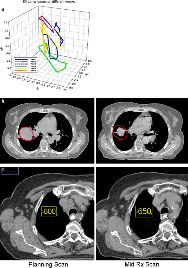 A review of image-guided radiotherapy | SpringerLink