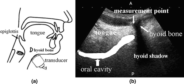 Sonographic assessment of hyoid bone movement during swallowing: a ...