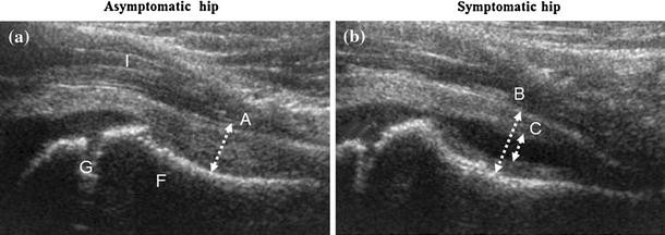 Sonographic measurement of transient synovitis in children: diagnostic ...