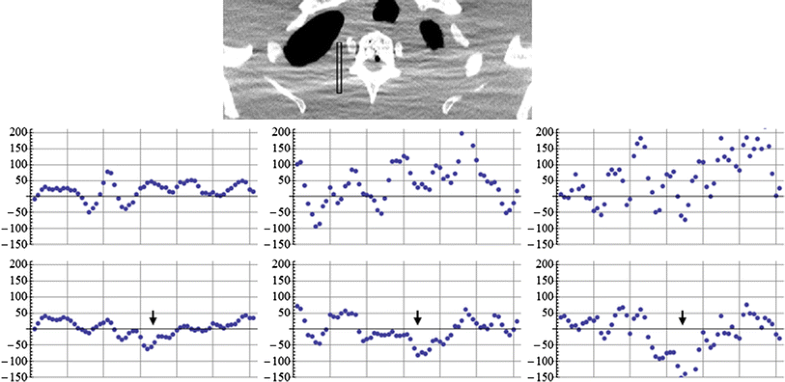 Photon starvation artifacts of X-ray CT: their true cause and a solution | SpringerLink