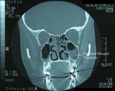 Acute maxillary sinusitis detected by bedside emergency department ...