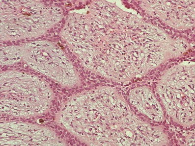 Fibroepithelioma of Pinkus in Continuity with Nodular Basal Cell ...