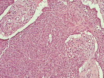 Fibroepithelioma of Pinkus in Continuity with Nodular Basal Cell ...